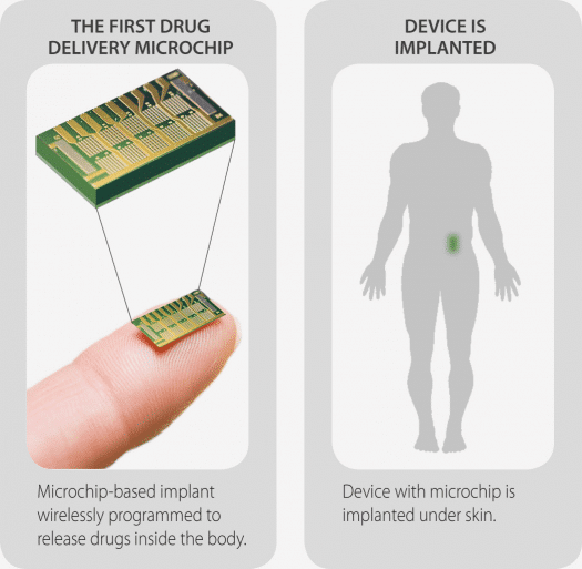 Microchip Drug Delivery – Guide du Parent Galactique